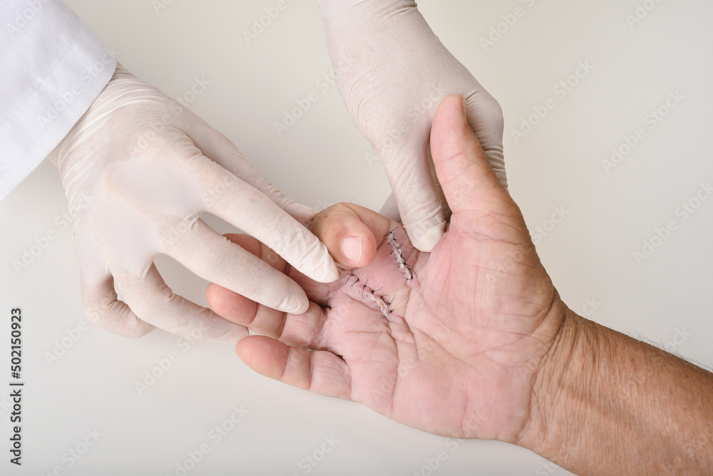 Hand surgery treatment, Trigger finger stiffness painful, Doctor treat ...