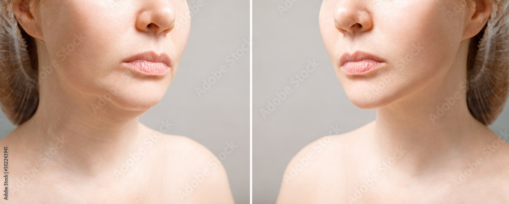 Female double chin before and after correction. Correction of the chin ...
