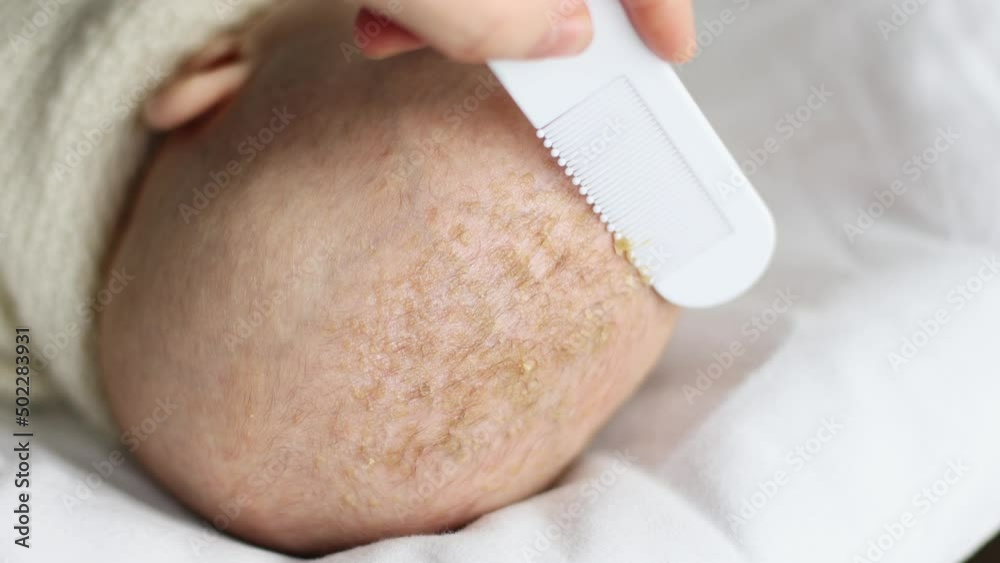 removing seborrheic dandruff flakes crusts off newborn baby child head ...