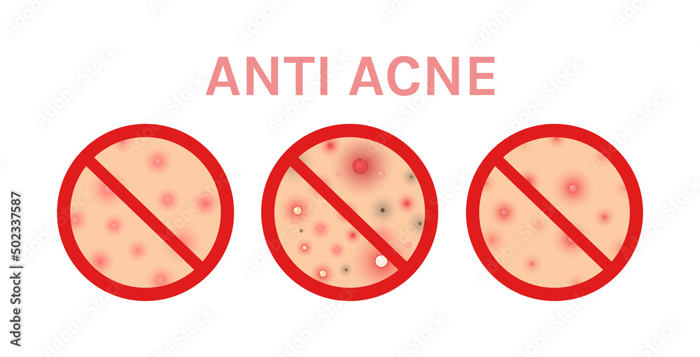 Anti Acne. Pimples and a Sign of Prohibition. Close Up of Acne. Problem ...