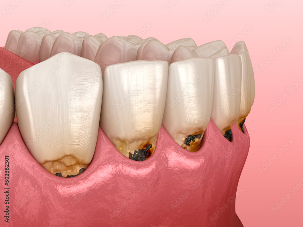 Cervical caries on frontal teeth. Dental 3D illustration Stock ...
