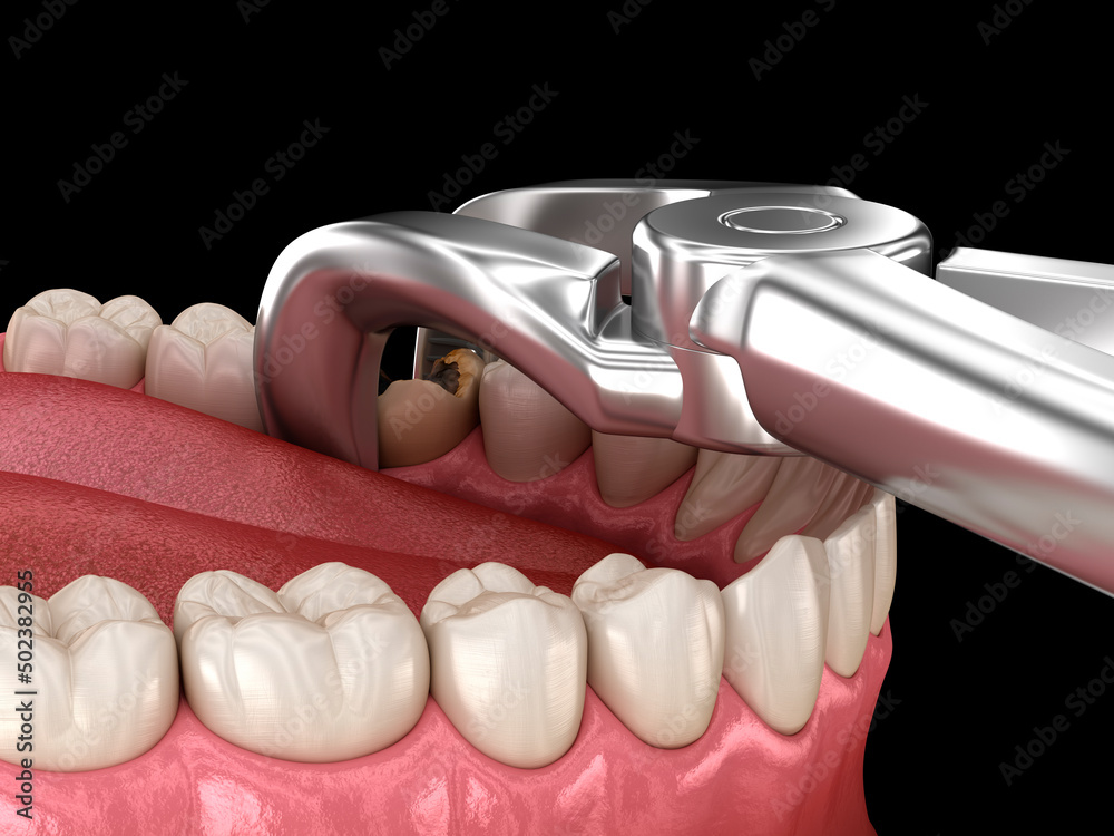 Extraction of Molar tooth damaged by caries. Dental 3D illustration ...