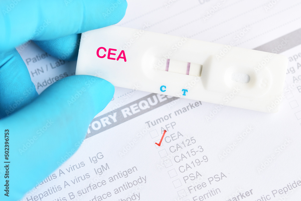 CEA or carcinoembryonic antigen positive by using rapid test ...