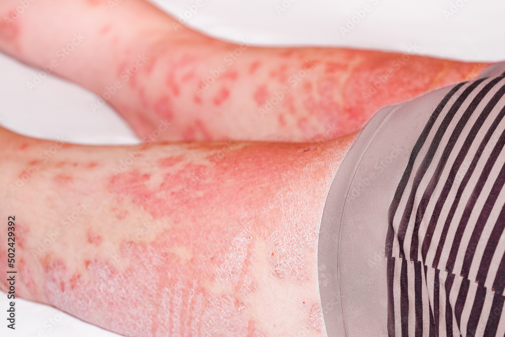 Acute Psoriasis Severe Reddening Of The Skin an Autoimmune incurable acute-psoriasis-severe-reddening-of-the-skin-an-autoimmune-incurable