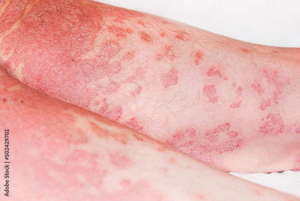 Acute psoriasis, severe reddening of the skin,an autoimmune,incurable ...