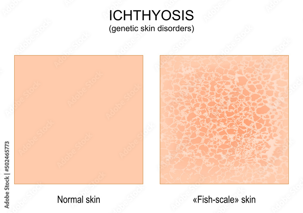 Ichthyosis. genetic skin disorders. Normal and skin of a person with ...