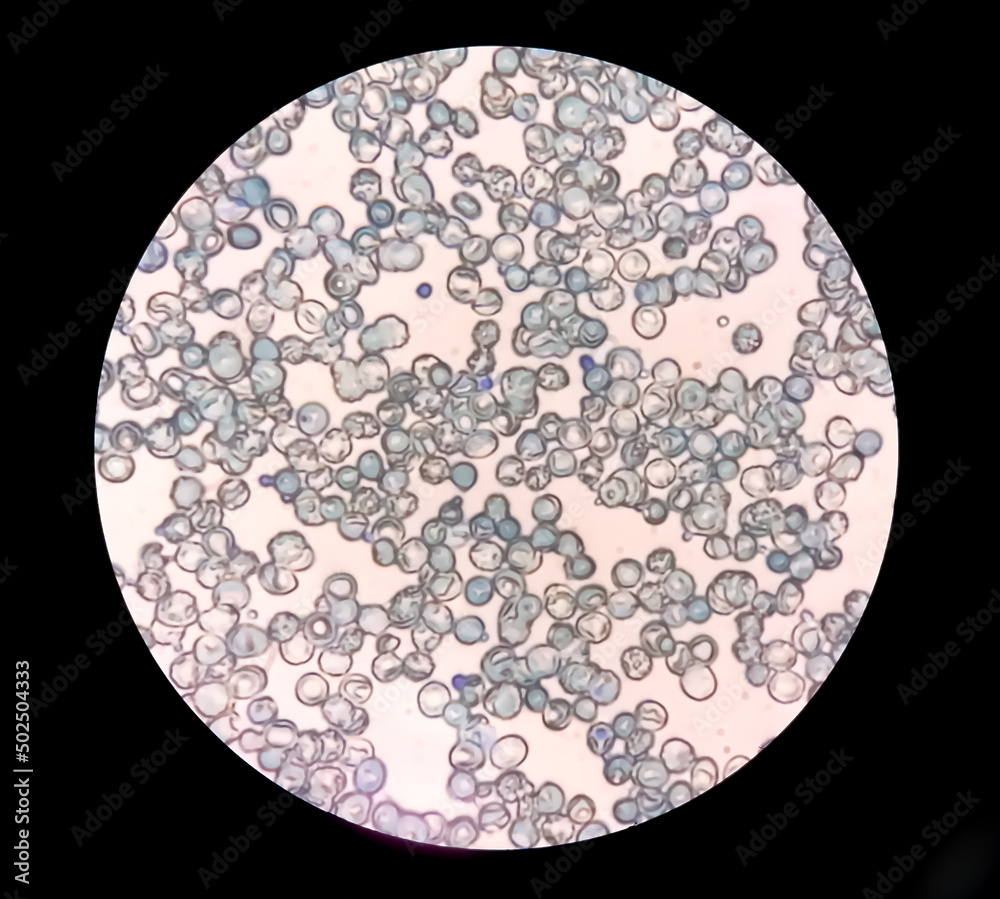 Microscopic view of abnormal reticulocyte count in hematology ...