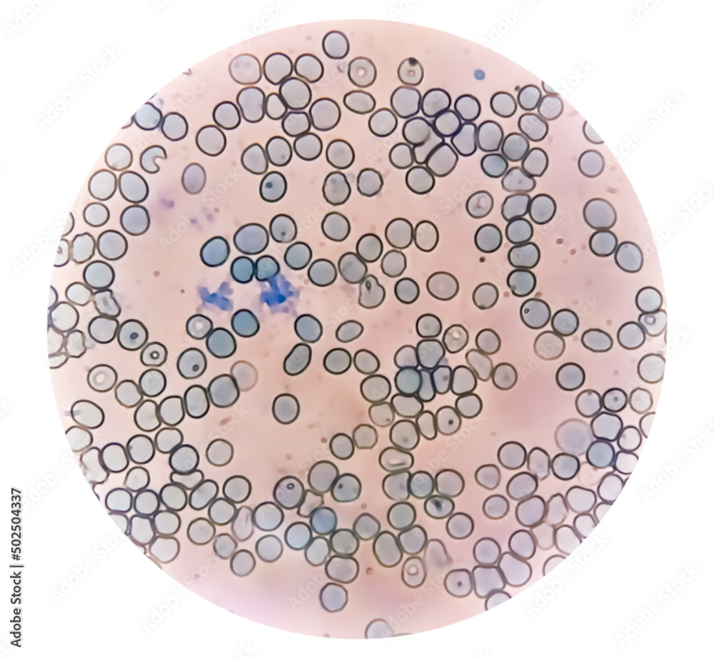 Microscopic view of abnormal reticulocyte count in hematology ...