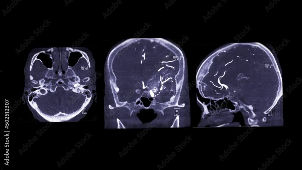 Cerebral angiography from Fluoroscopy in intervention radiology showing ...