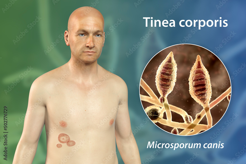 Fungal infection on a man's body. Tinea corporis, 3D illustration Stock ...