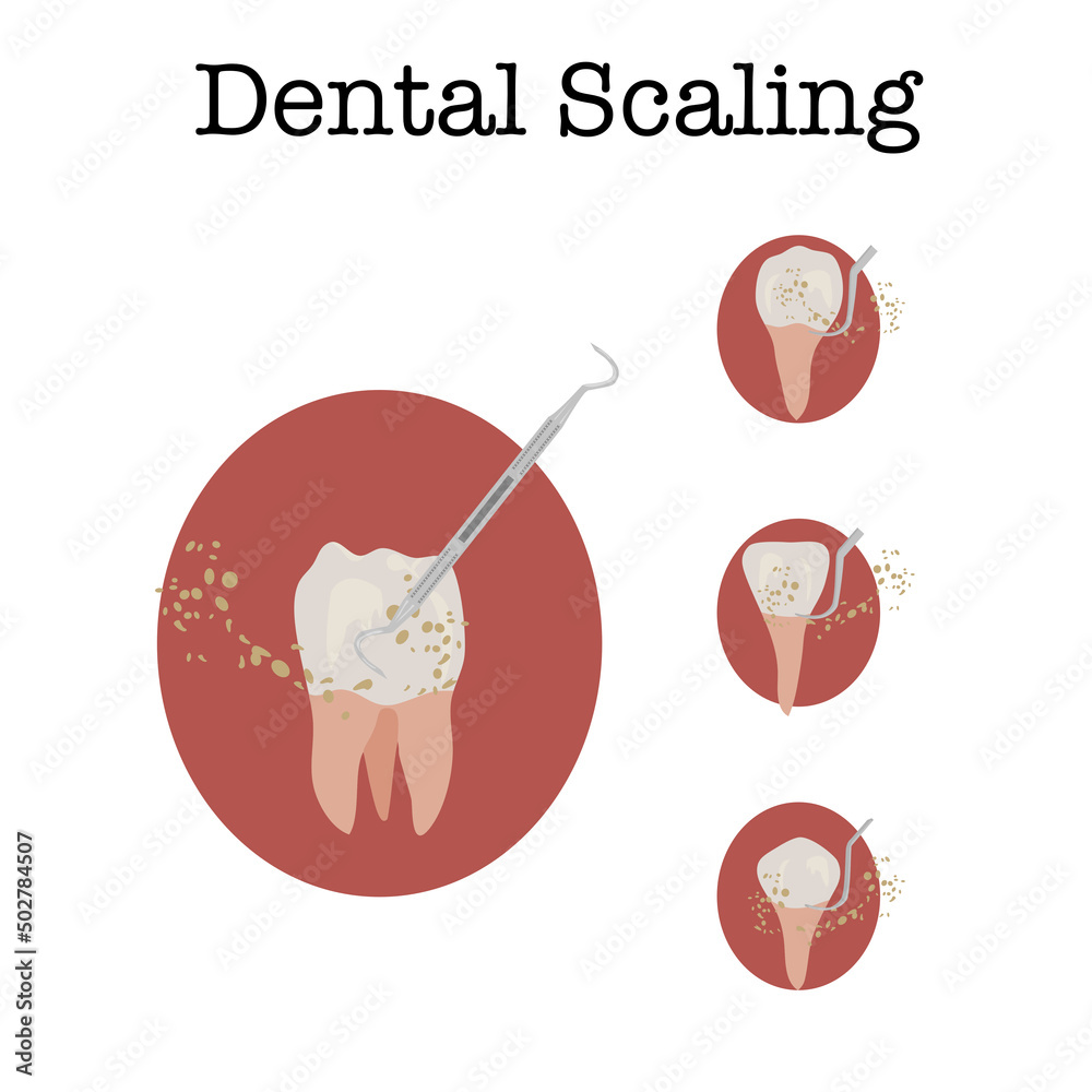 Dental Scaling set.Teeth 4 types with Dental Scaling text on top with ...