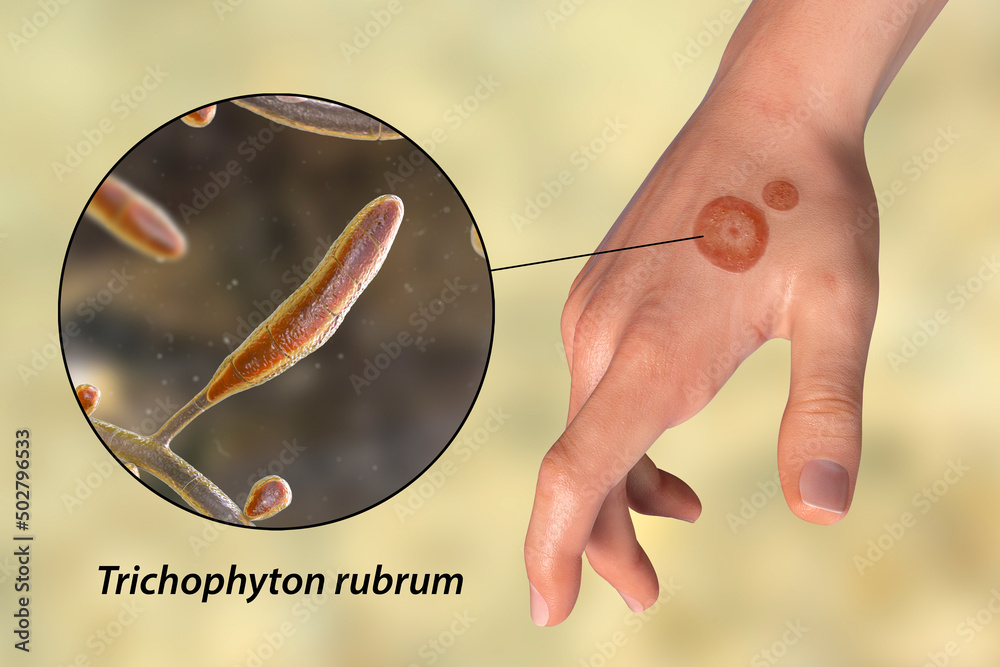 Fungal infection on a man's hand. Tinea manuum and close-up view of ...