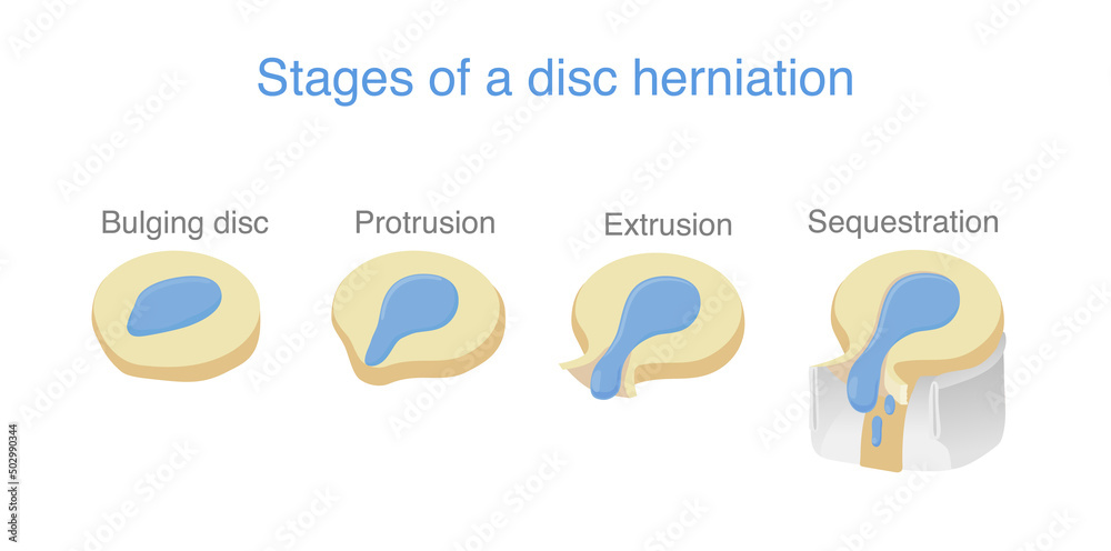 4 Stage of disc herniation. Medical diagram about spine problems that ...