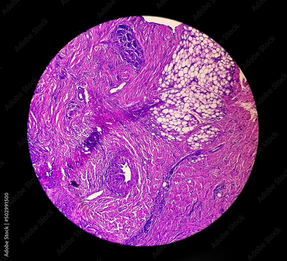 Skin Cancer: Skin biopsy under microscope showing Basal cell carcinoma ...