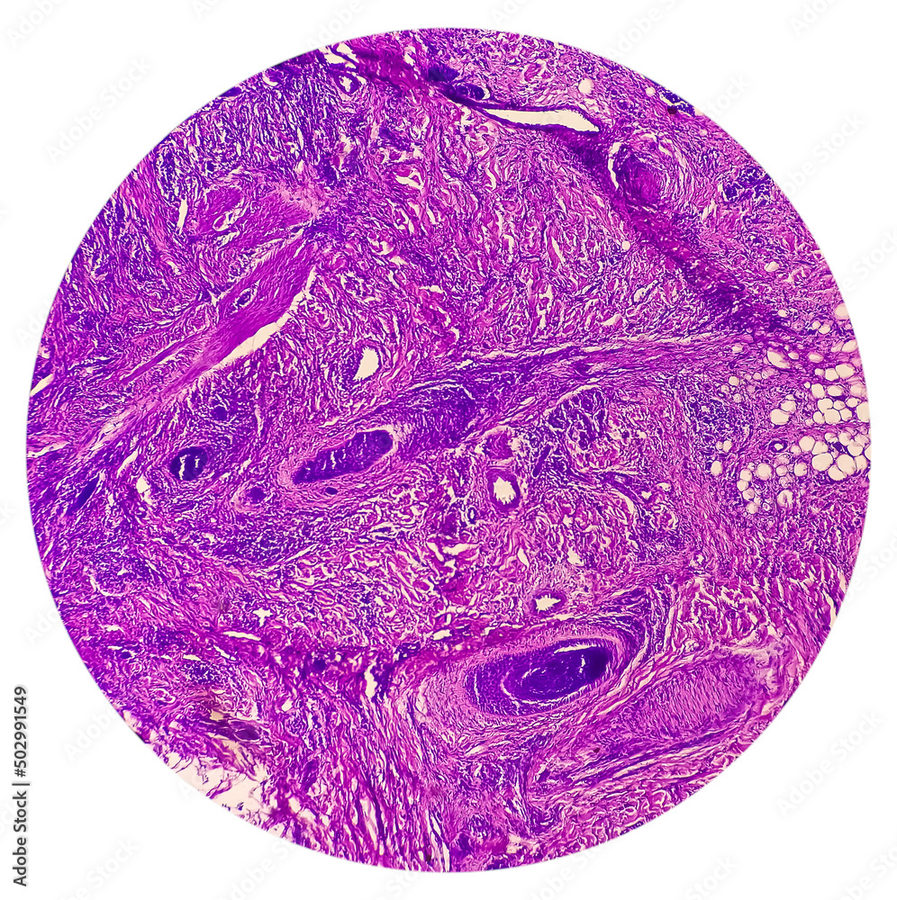 Skin Cancer: Skin biopsy under microscope showing Basal cell carcinoma ...