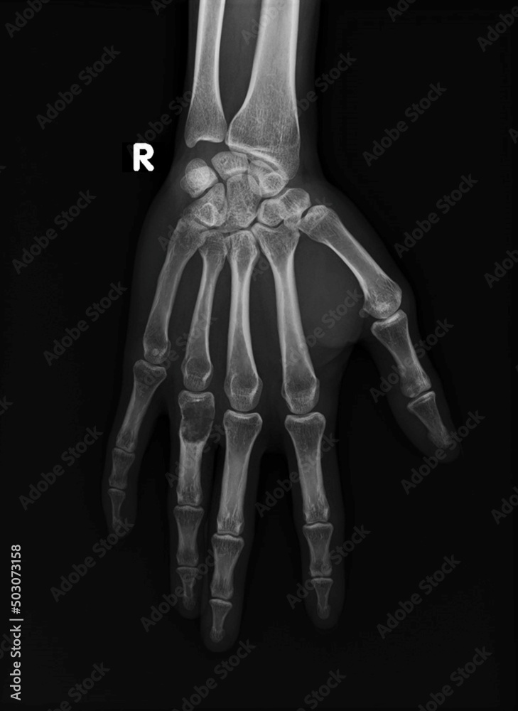 Enchondroma of the hands demonstrates a well-defined, lucent, central ...