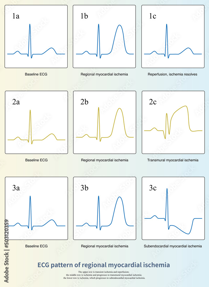 Different myocardial ischemia has different pathophysiological ...