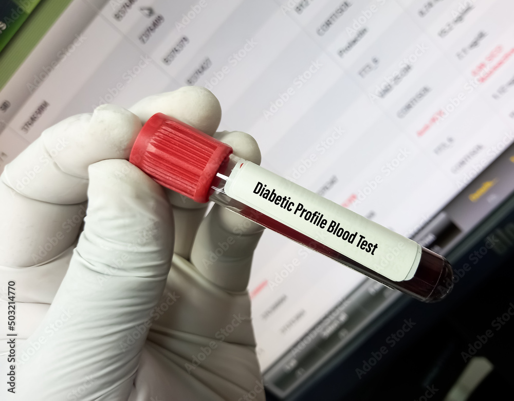 Blood sample tube for analysis of Diabetes profile blood test in ...