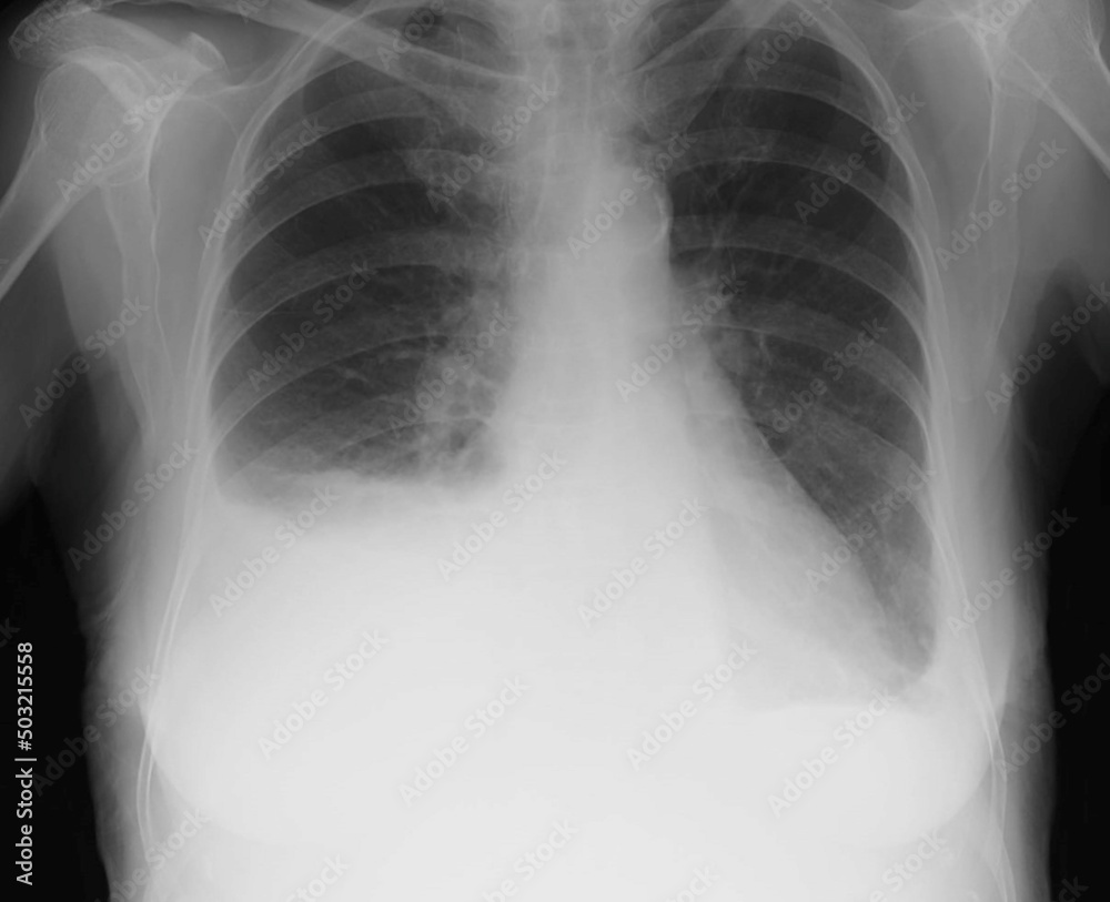 Pleural effusion in chest x-ray Stock Photo | Adobe Stock