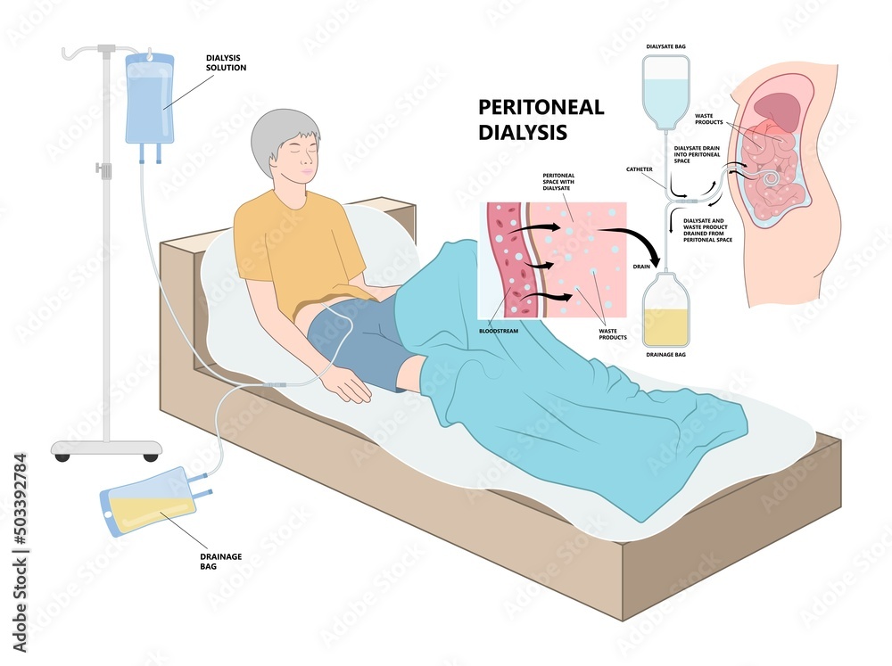 dialysate cleansing home care tube fluid drain bag waste High blood ...