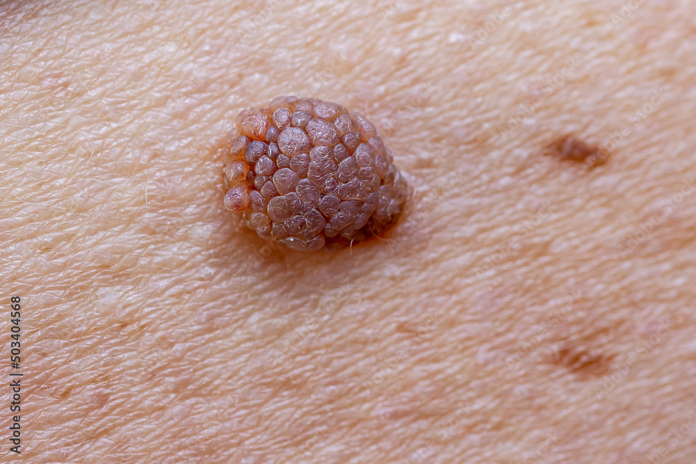 Oncology mole big wart on skin old woman. Concept dermatology body ...