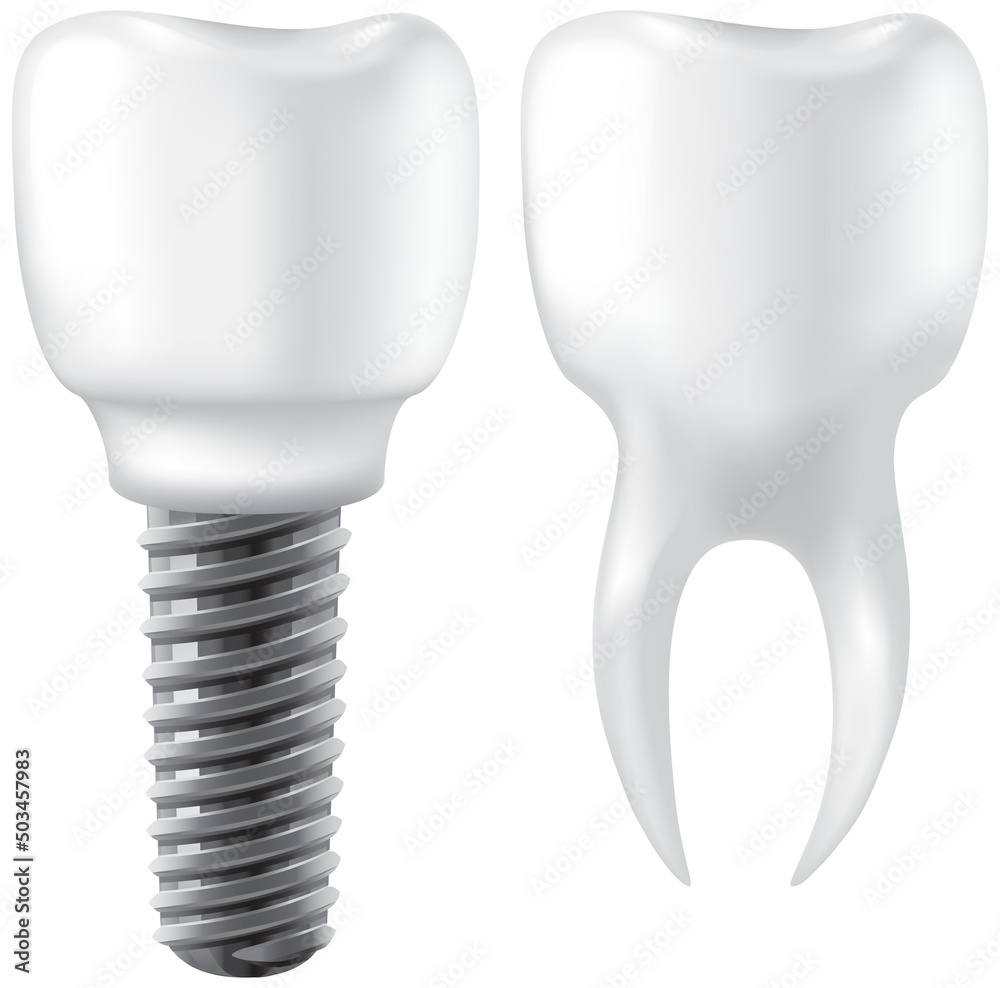 Realistic white dental implant and human tooth. Dentistry, medicine and ...