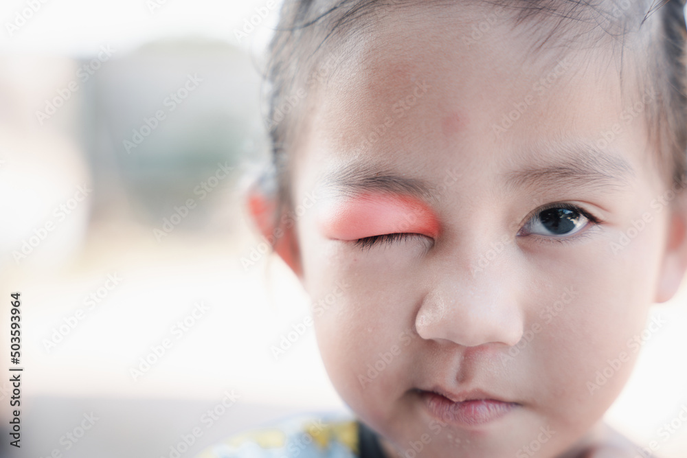 Stye Eye diseases. Closed Asian kid little girl eye with sty, eyelid ...