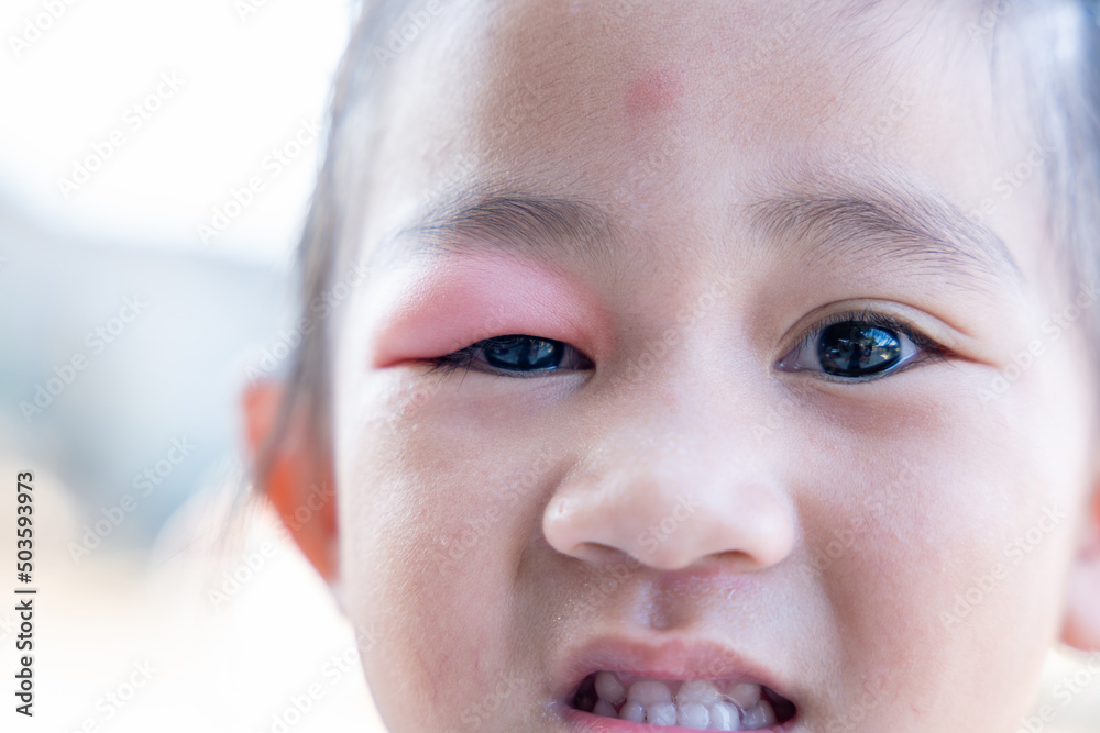 Stye Eye diseases. Closed Asian kid little girl eye with sty, eyelid ...