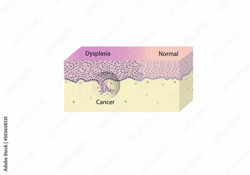Morphology Of Cervical Cancer And Dysplasia Under A Microscope