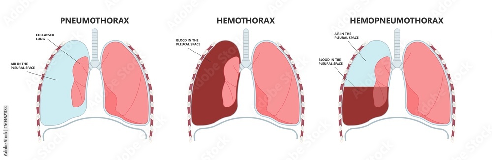 Lung cancer collapse chest pain drain rib bleb blunt insert tube fluid ...