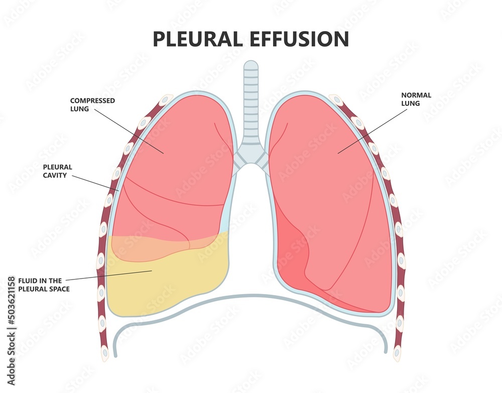 Lung cancer collapse chest pain drain rib bleb blunt insert tube fluid ...