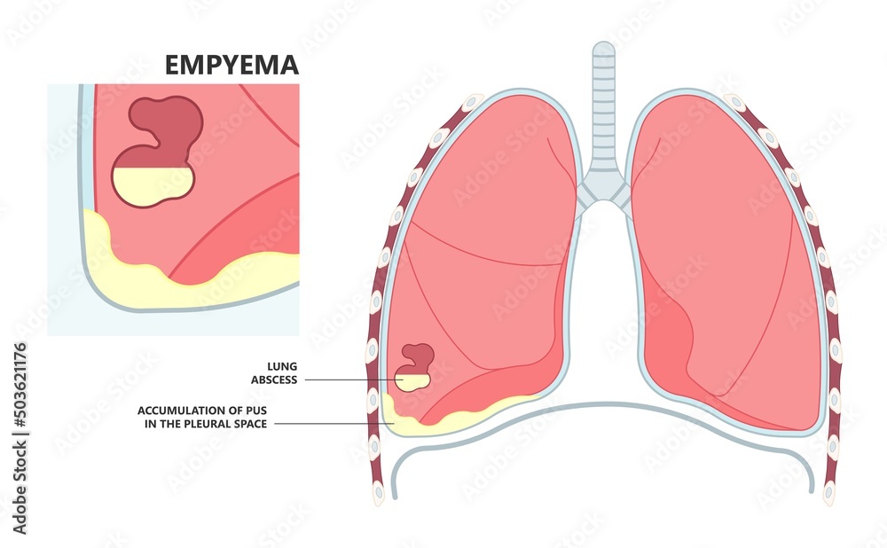 Vetor de Lung cancer collapse chest pain drain rib bleb blunt insert ...
