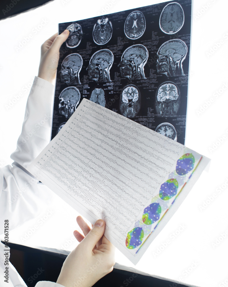 Epileptologist examines patient MRI and electroencephalogram. Concept ...