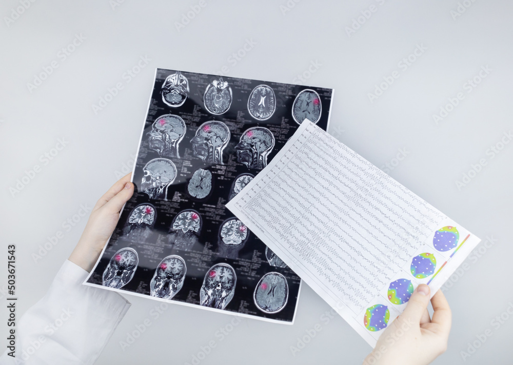 Epileptologist examines patient MRI and electroencephalogram. Concept ...