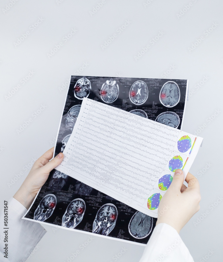 Epileptologist examines patient MRI and electroencephalogram. Concept ...