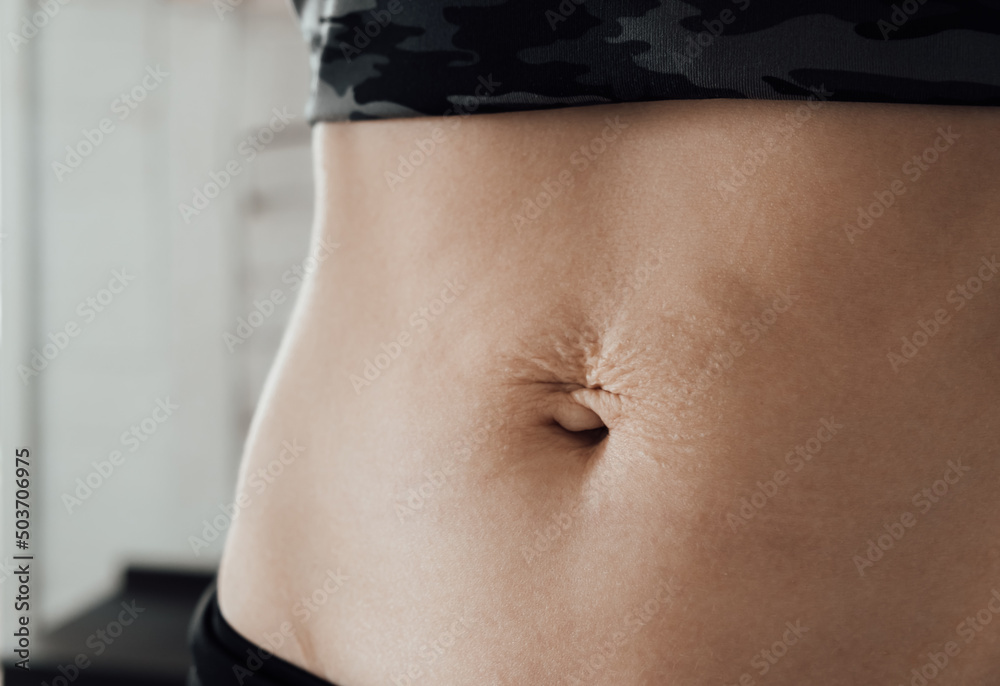 Skin. Abdomen of woman after the child birth by Cesarean section ...