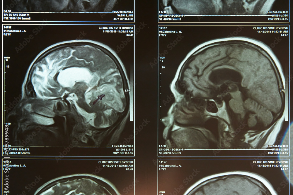 A fragment of an image of an elderly person's brain scan on magnetic resonance imaging MRI film ...