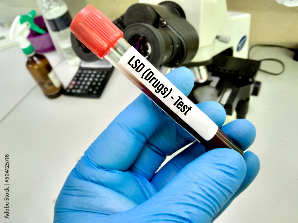 Doctor's hold Urine drug screen test sample, also known as a urine drug ...