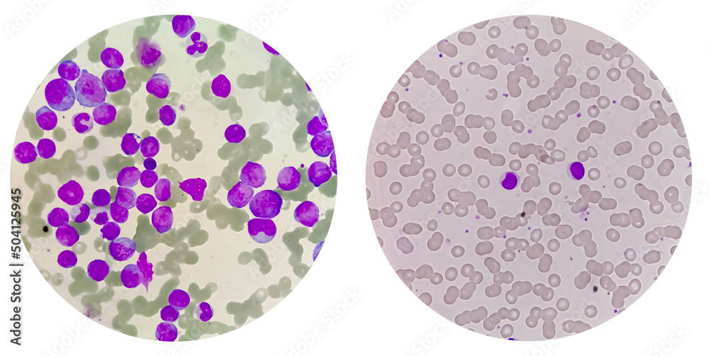 Photo college of Acute myeloid leukemia (AML) is a type of blood cancer ...