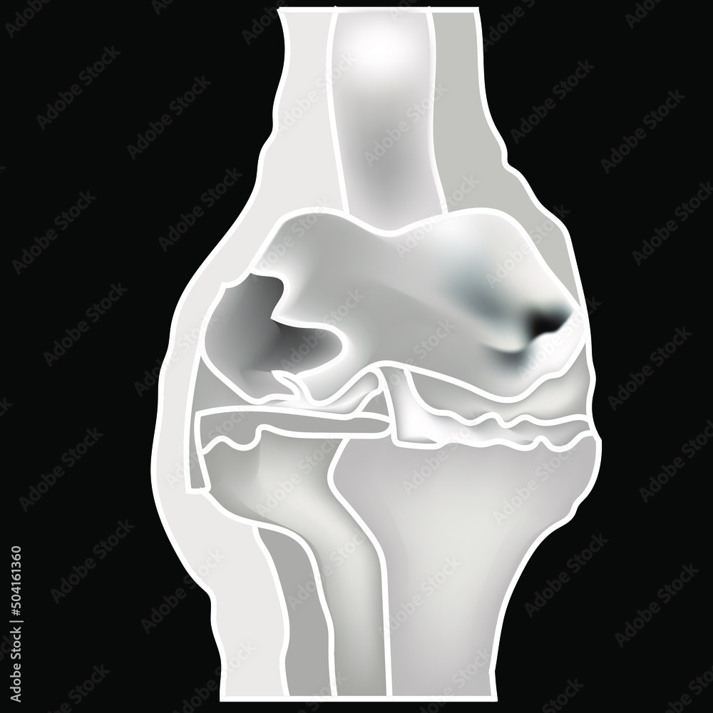 Bone loss stock illustration. The vector image is related to a health ...