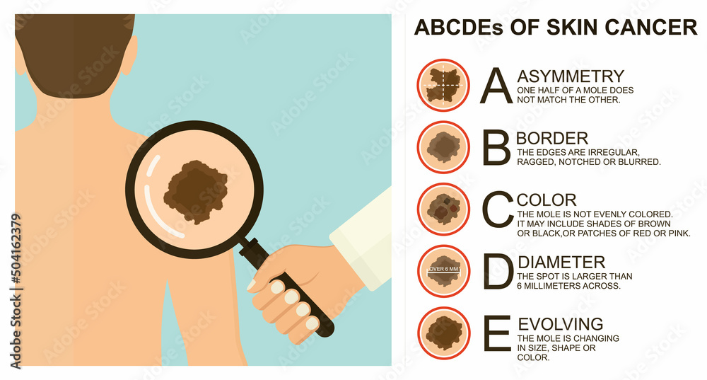Diagnosis of skin cancer. Melanoma warning signs. Dermatological ...