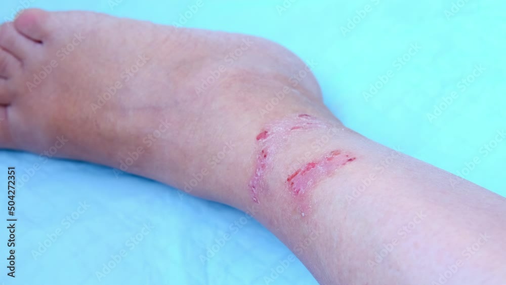 close-up of human shin, doctor treats numerous wounds on leg of adult ...