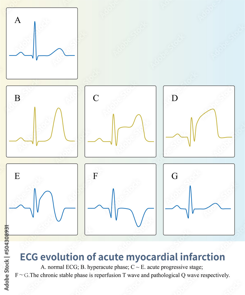 Pathological Q Wave