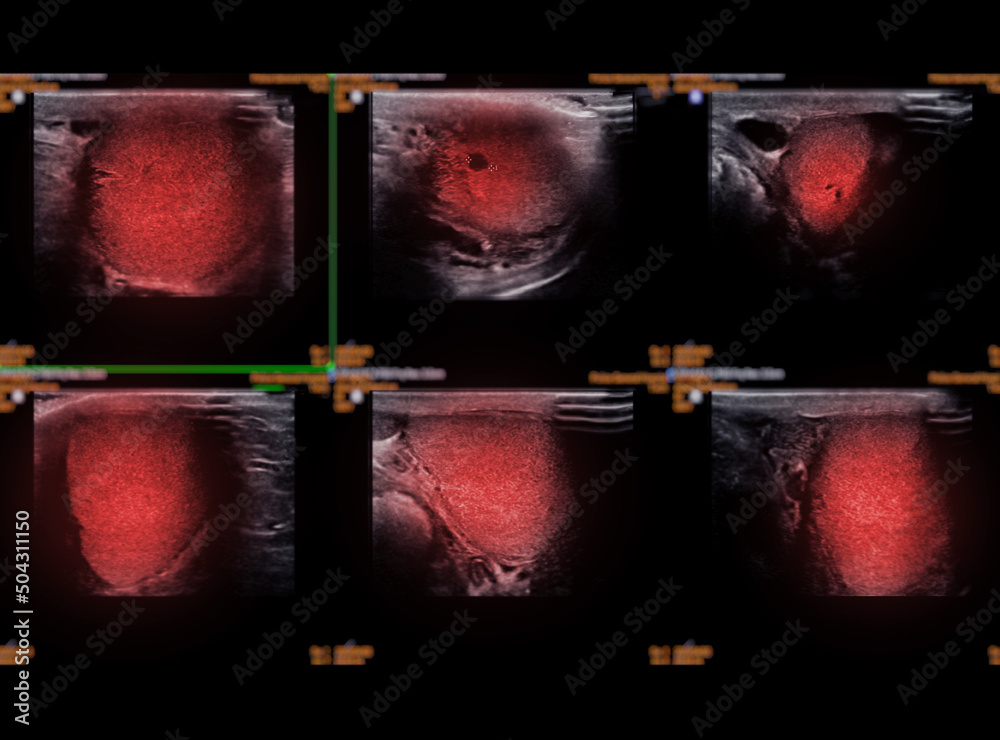 Ultrasonography Of Thyroid Gland For Diagnostics Of The Thyroid Gland