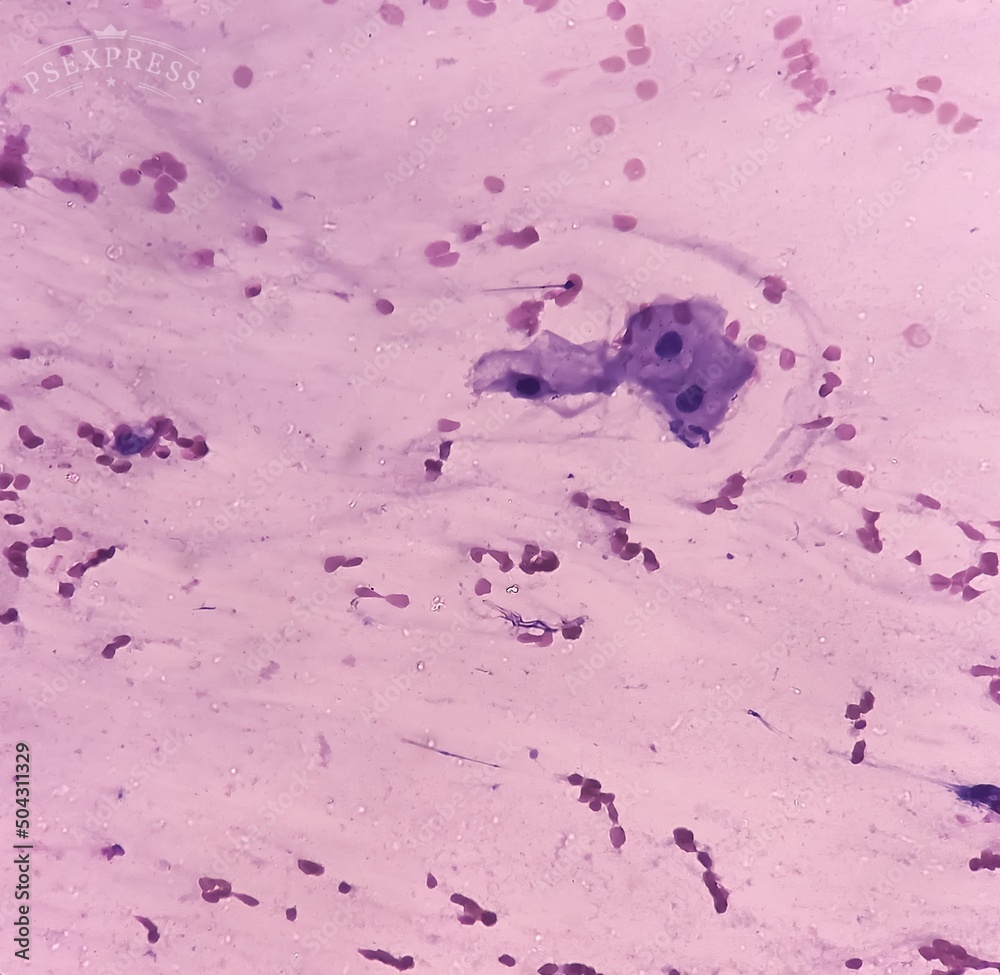 Microscopic view of vault smear showing reactive cellular changes with ...