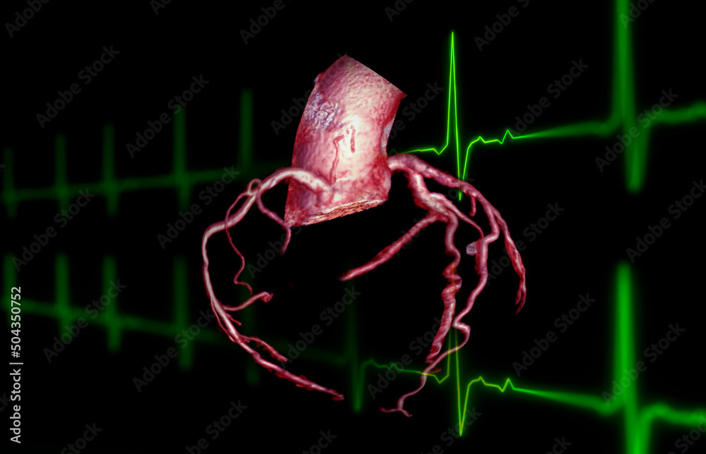CTA Coronary artery 3D rendering image on the screen for diagnosis of ...