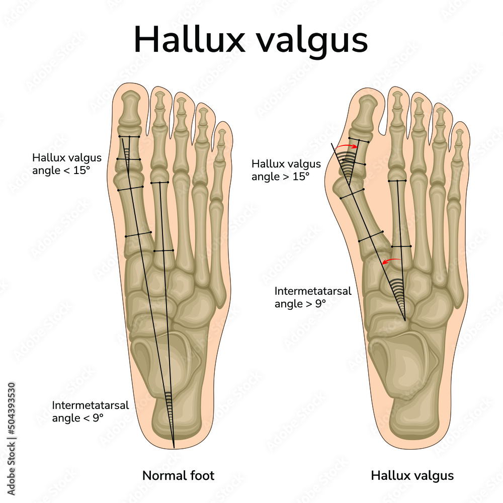 An illustration of the location of the bones in a healthy foot and ...