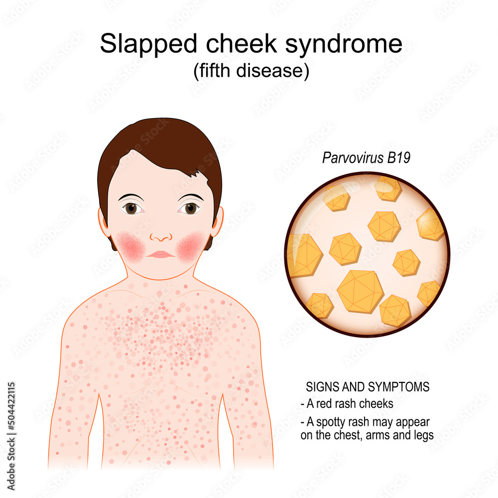 child has slapped cheek syndrome. Infectious disease. Close-up of ...