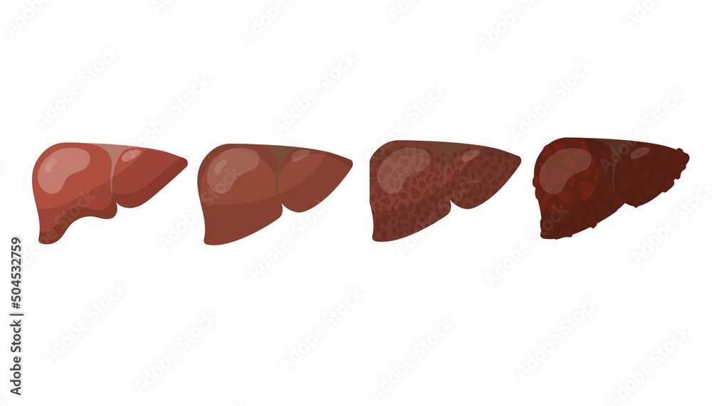 Stages of human liver destruction cartoon illustration set. Person ...