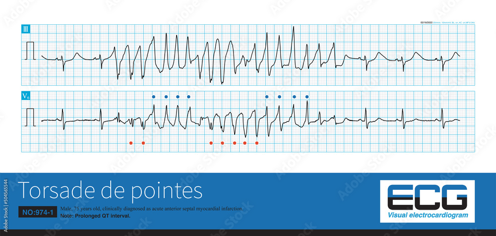 Male, 75 years old, clinically diagnosed as acute anterior septal ...